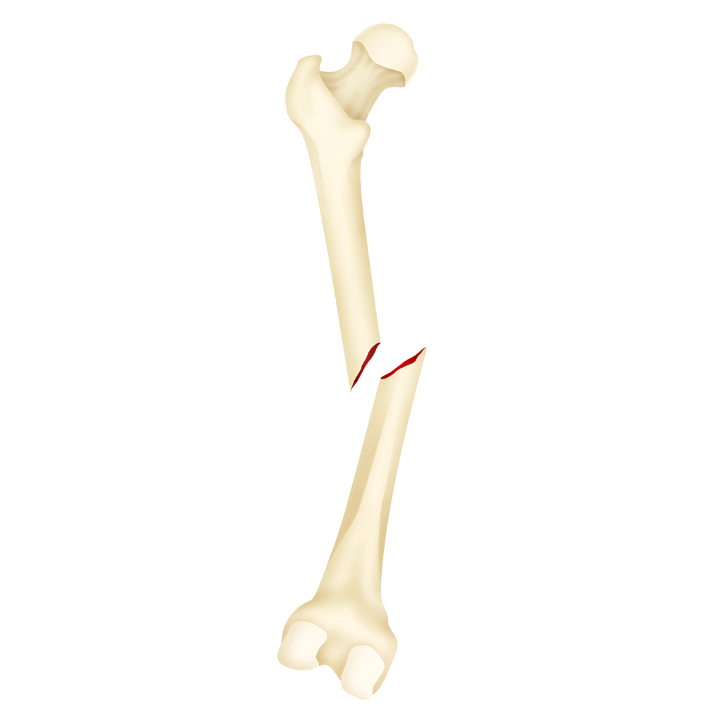 Bone Fractures in Adults: Types, Causes, & Preventive Methods
